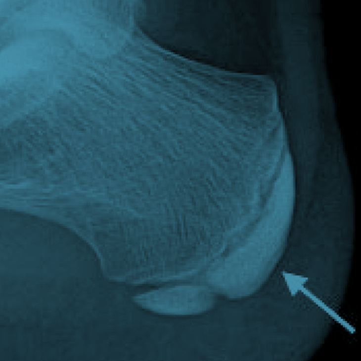 problems_severs_disease - Pods Fix Feet